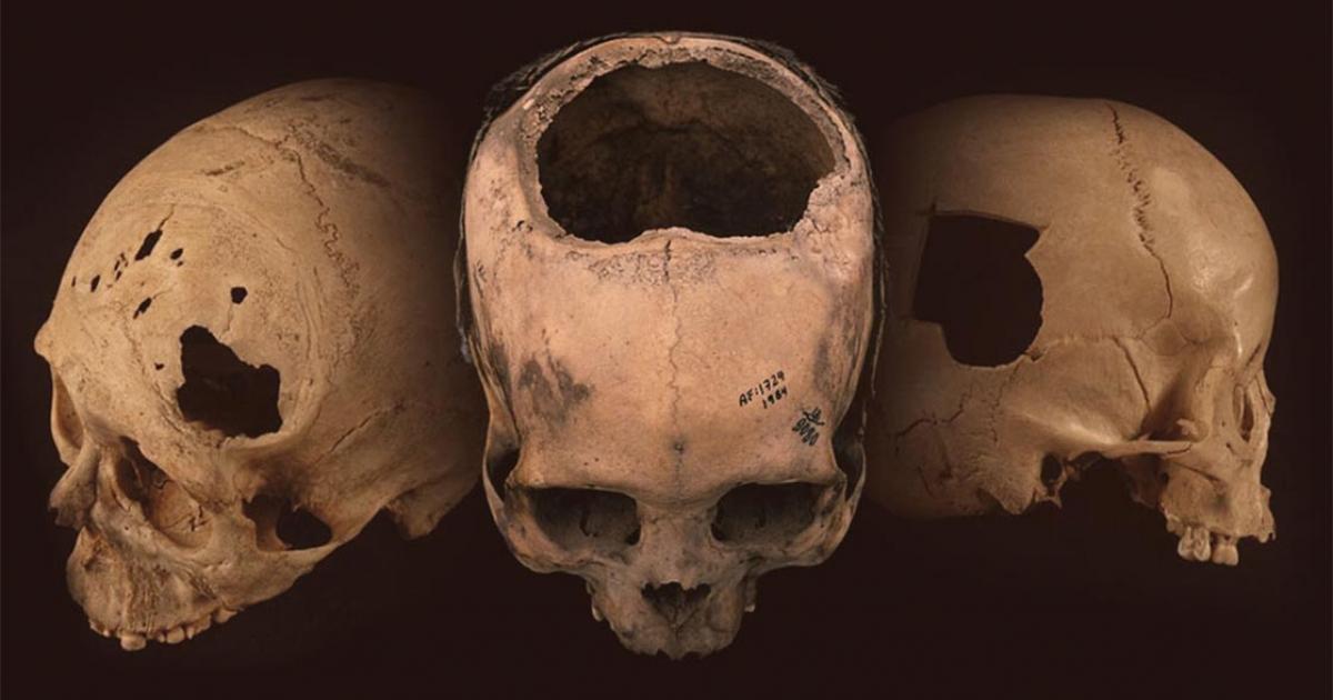 Trephination: The Oldest Evidenced Surgery Still in Use Today ...