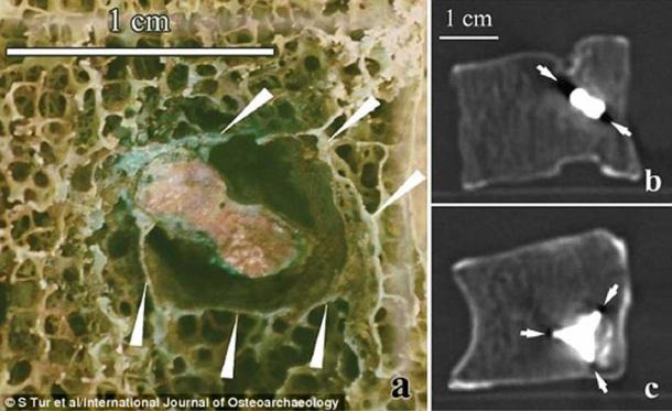 The Warrior Who Survived with an Arrow Embedded in His Spine | Ancient ...