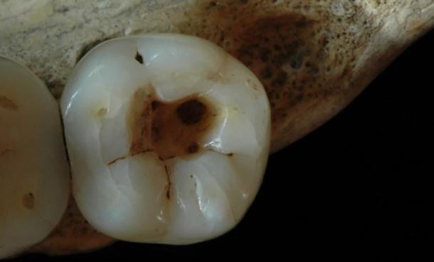 Jewel-Capped Teeth and Golden Bridges: 14,000 Years of Dentistry ...