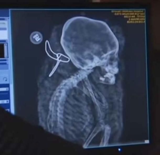 Peruvian Mummy Taken to Children’s Hospital for Revealing X-rays ...