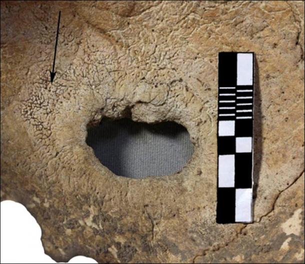 Reconstructing Brain Surgery as It Was Conducted Around 3,000 Years Ago ...