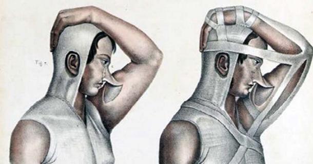 The Ugly History of Cosmetic Surgery | Ancient Origins