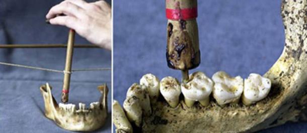 13,000-Year-Old Bitumen Dental Fillings Found in Italy: Earliest ...