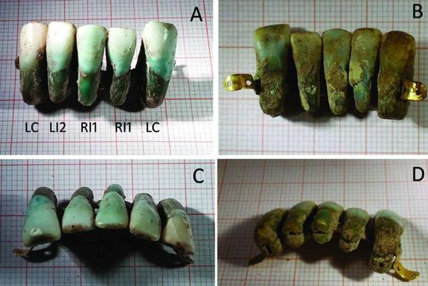 Archaeologists Find Medieval Dentures Made from the Teeth of Dead ...